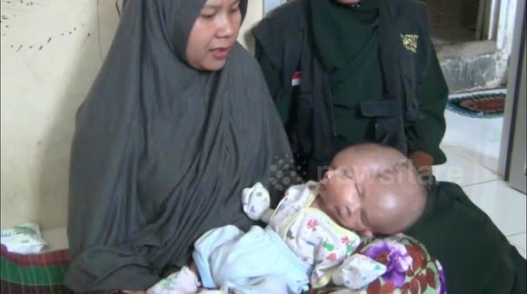 Baby born in Indonesia with two faces in desperate need of surgery ...