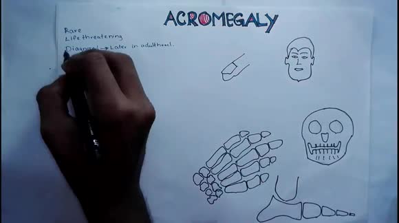 ACROMEGALY : Pathophysiology, Causes, Signs and symptoms, Treatment and ...
