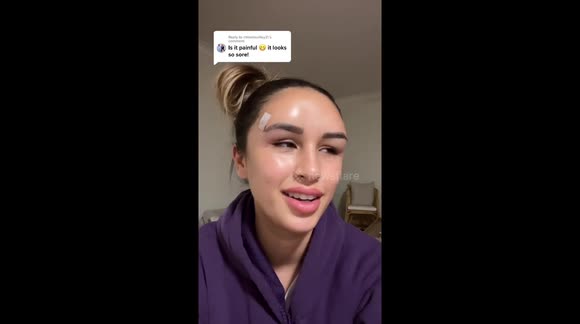 Model, 21, who looked like 'alien with horns' from botched thread lift ...