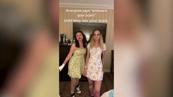 US woman with rare skin condition says her skin is so fragile it's like ...