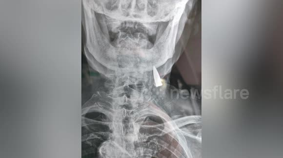 Chinese war veteran, 95, shocks medics with bullet stuck in his neck ...