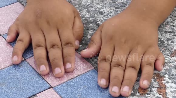 Thai schoolboy born with 24 fingers and toes shows off his digits - Buy ...
