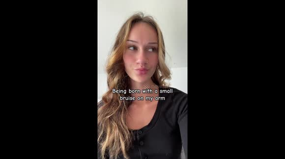 TikTok star with 'HULK' arm that trolls say to 'amputate' leaves ...