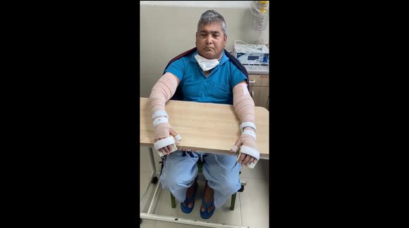 Header - Double amputee who lost limbs in accident gets woman hands ...