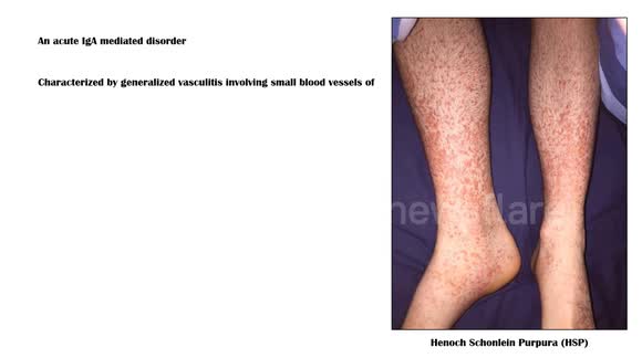 Henoch Schoenlein Purpura (HSP) - Causes, Pathophysiology, Diagnosis ...