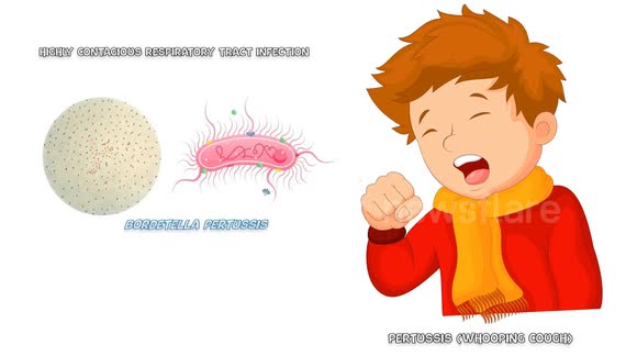 Pertussis (Whooping Cough) - Causes, Signs & Symptoms, Complications, Diagnosis, And Treatment ...