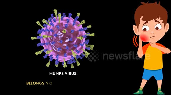Mumps - Causes, Signs & Symptoms, Diagnosis, And Treatment - Buy, Sell ...