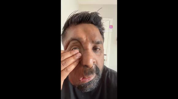 Exclusive- Breaking the stigma: Viral prosthetic eye video sparks ...