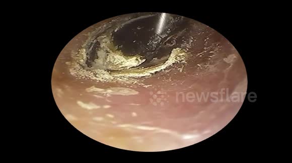 White mushroom covered the beetle carcass inside the man's ear cana ...